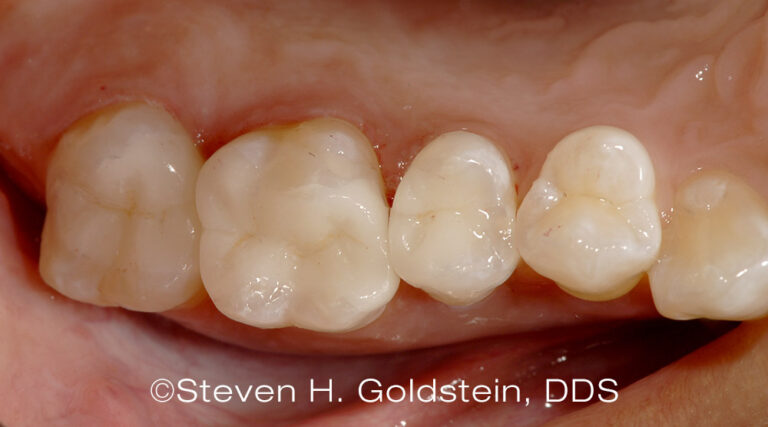 Bonded Porcelain Inlays - Dental Case of the Month